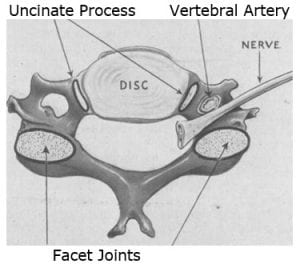 Whiplash Injury and the Uncinate Process